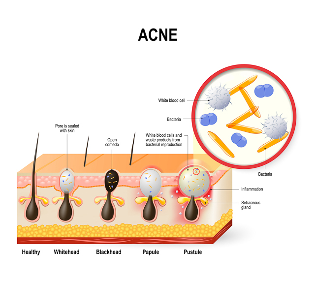 What Is Cystic Acne Cystic Acne